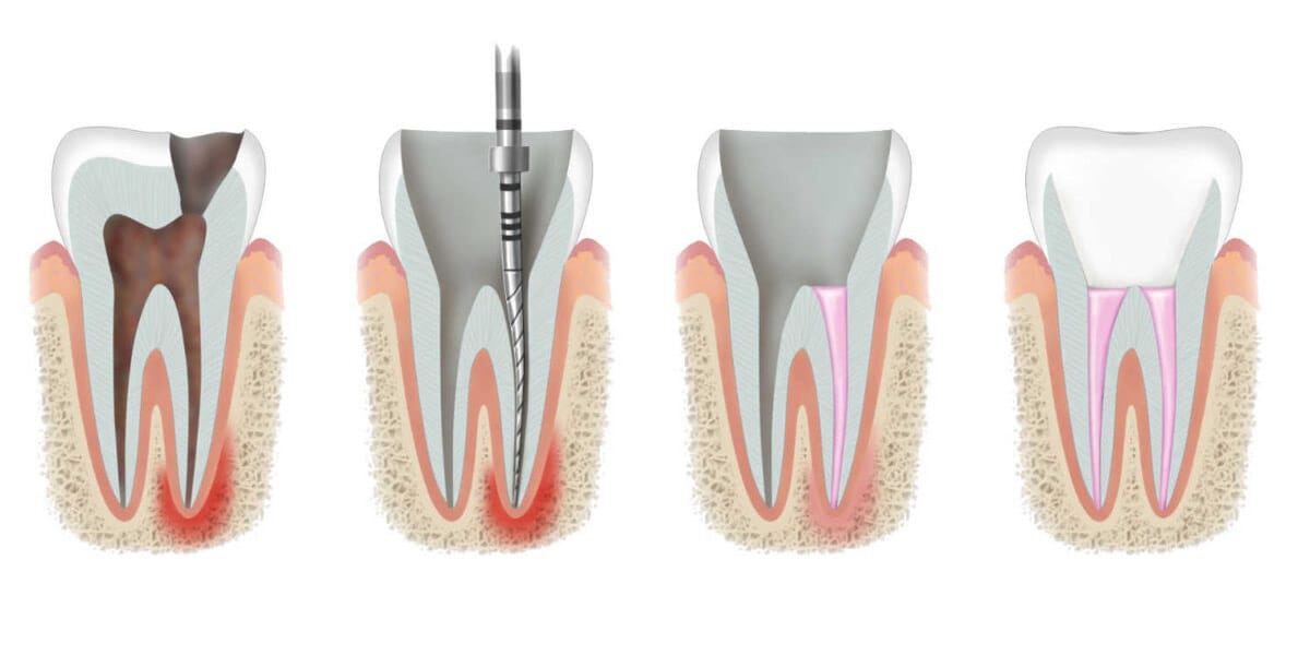 Root Canal Treatment in Kayseri | Expert Dentist Dr. Emin ÜN